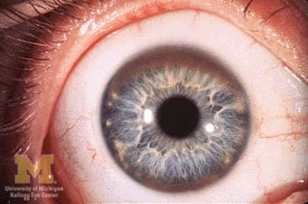 The Eyes Can Tell a Story: Copper Rings and Sunflower Stars – Patient ...