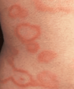 The Anatomy of an HAE Attack - Part 1 - Patient Worthy