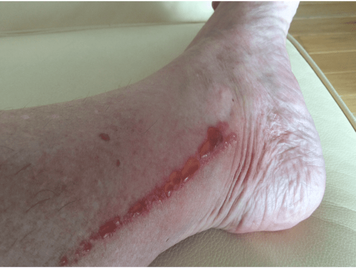 A Pemphigus Vulgaris Advocate’s Plea – Patient Worthy
