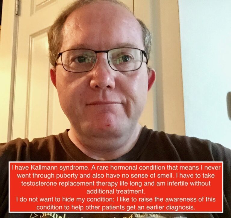 Kallmann Syndrome: Absent Puberty – Patient Worthy