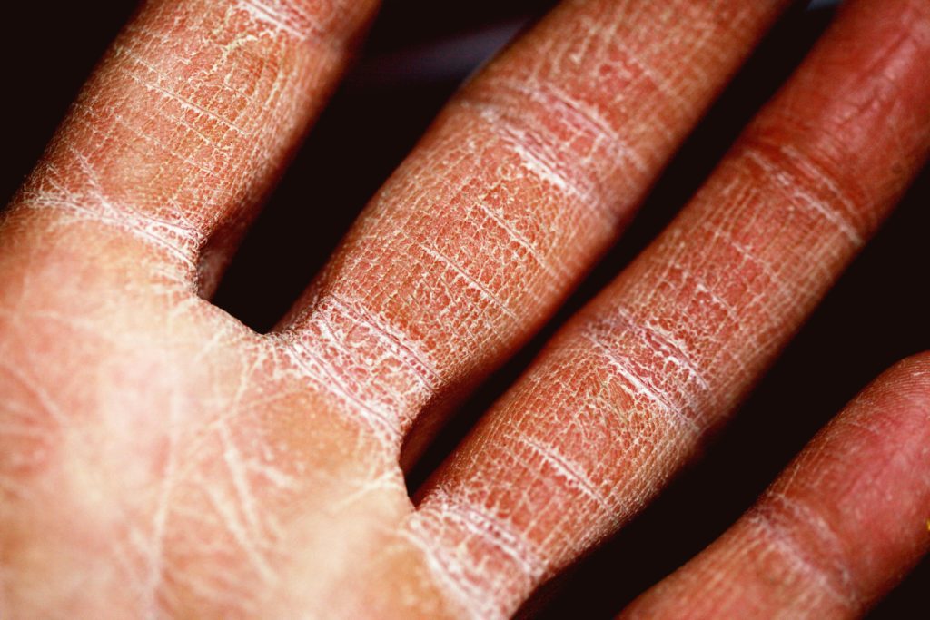 Diffuse Systemic Scleroderma Causes Worse Outcomes Patient Worthy